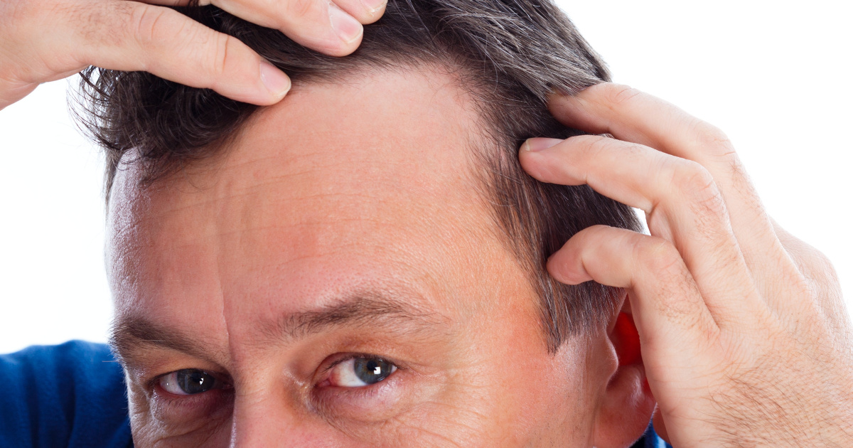 Todo lo que necesitas saber sobre el injerto capilar FUE (y BioFUE ...